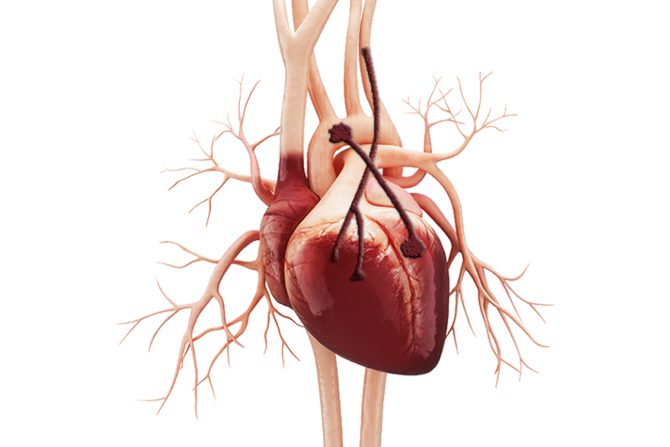 Coronary Artery Bypass | GlobeHealer