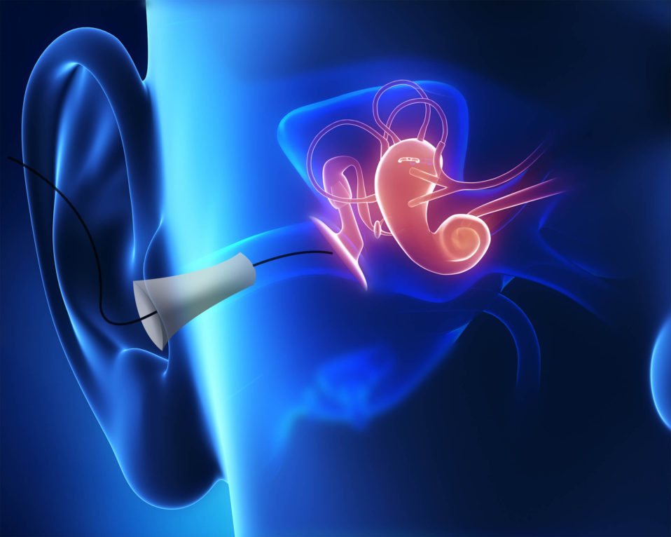 Electrochochleography (ECOG) | GlobeHealer