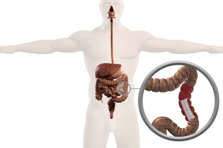 Luminal Stenting | GlobeHealer