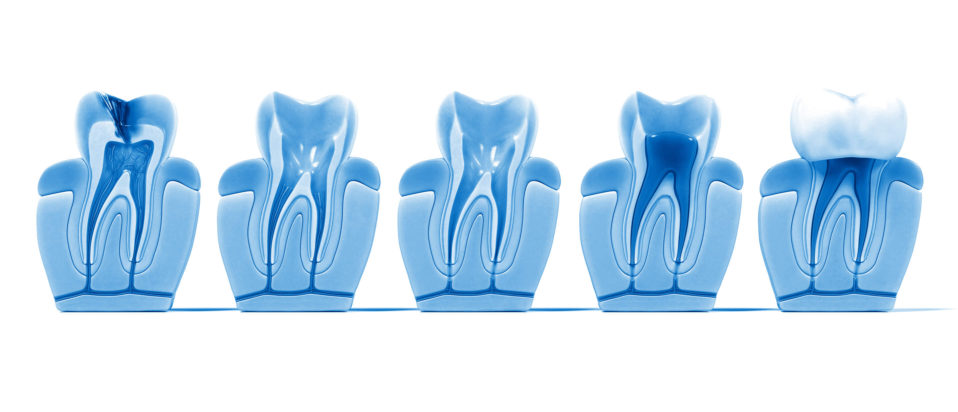 Pulp Removal | GlobeHealer