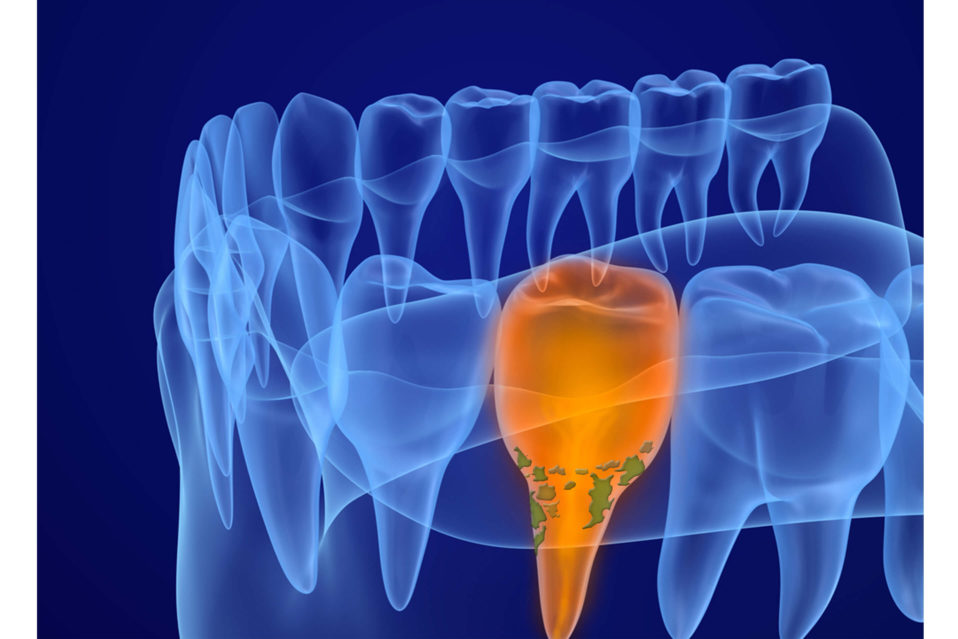 Root Planing | GlobeHealer