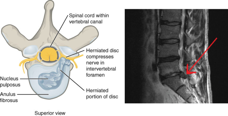 Percutaneous Transforaminal Lumbar Interbody Fusion | GlobeHealer