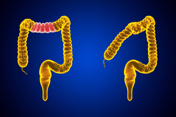 Colectomy | GlobeHealer