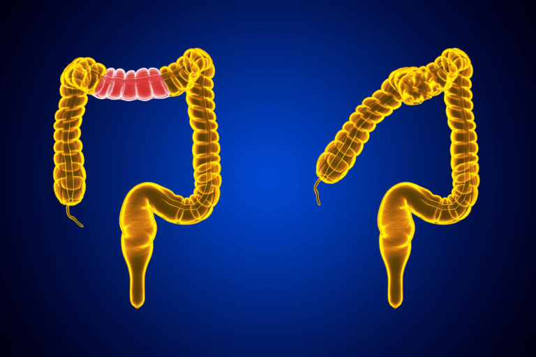 Colectomy | GlobeHealer