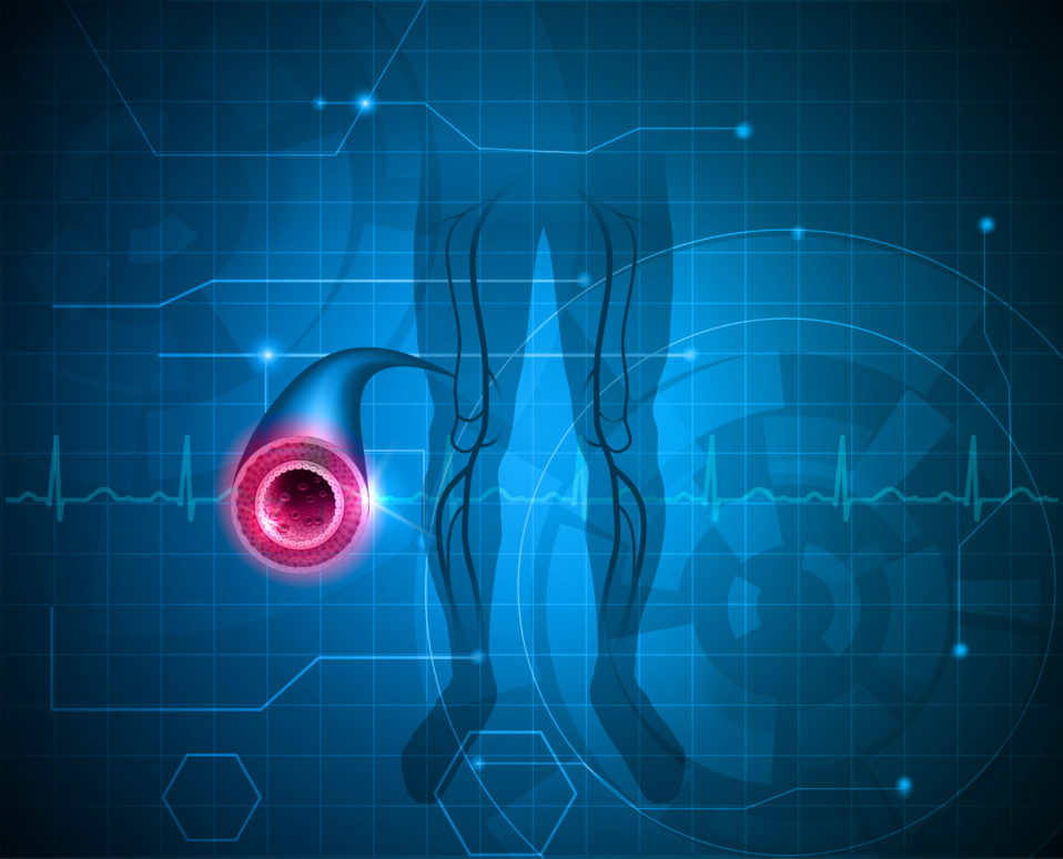 Peripheral Vascular Reconstruction | GlobeHealer